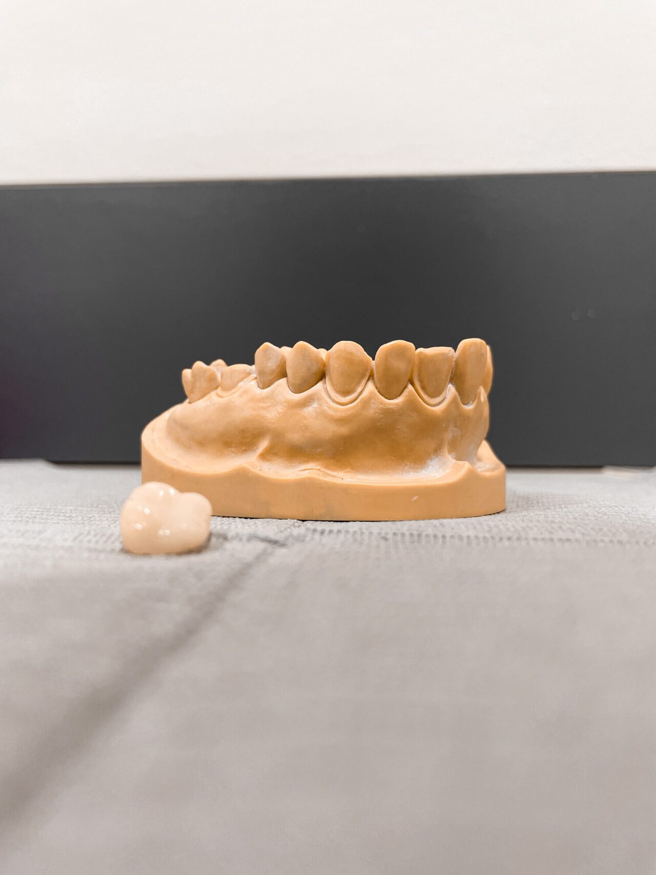 Ceramic Onlays | Smile Inc - Centurion Dentist